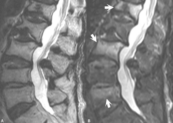Fat Suppression: Short Tau Inversion Recovery (STIR) | Radiology Key