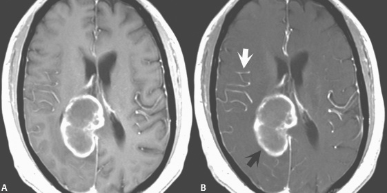 Magnetization Transfer | Radiology Key