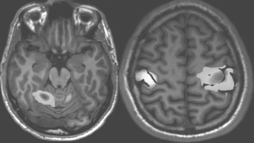 Blood Oxygen Level-Dependent (BOLD) Imaging: Applications | Radiology Key