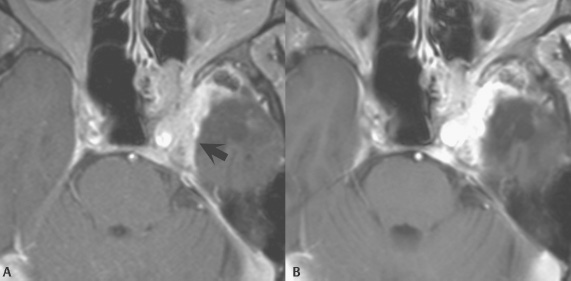 Slice Thickness | Radiology Key