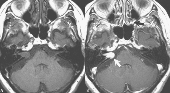 SNR Versus CNR | Radiology Key