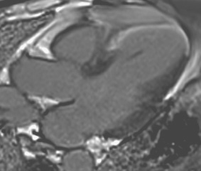 Cardiac Imaging: Myocardial Viability | Radiology Key