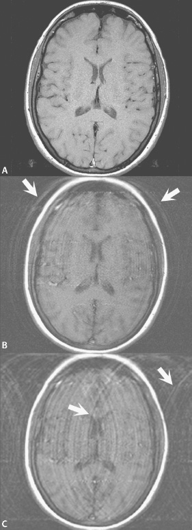 Gradient Moment Nulling | Radiology Key