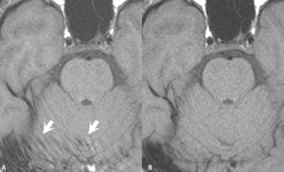 Spatial Saturation | Radiology Key