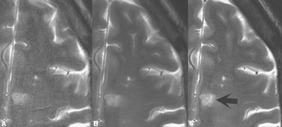 SNR at 3 T | Radiology Key
