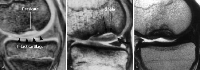 Ischemic Bone Disease | Radiology Key