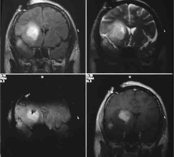 High-Field Brain Biopsy | Radiology Key