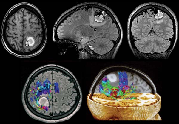 Intraoperative Magnetic Resonance Imaging and Cerebrovascular Surgery ...
