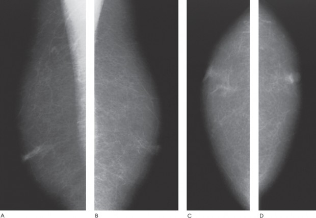 Staging Breast Cancer | Radiology Key