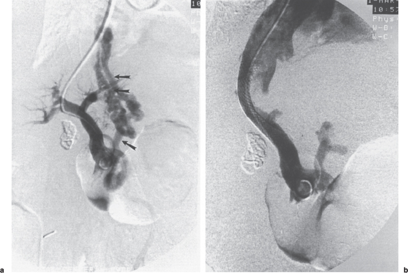 Percutaneous Intervention of Malfunctioning Surgical Portosystemic ...