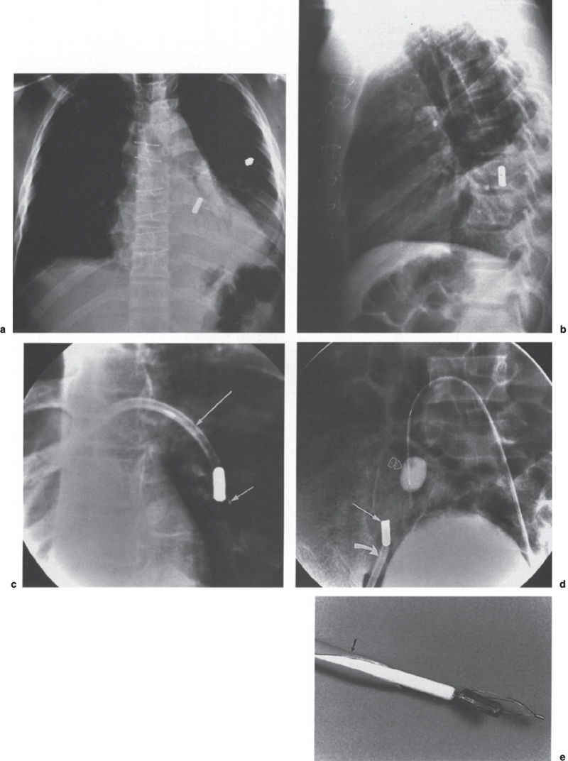 Foreign Body Retrieval | Radiology Key