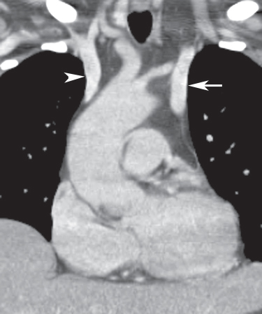 8 Persistent Left Superior Vena Cava | Radiology Key