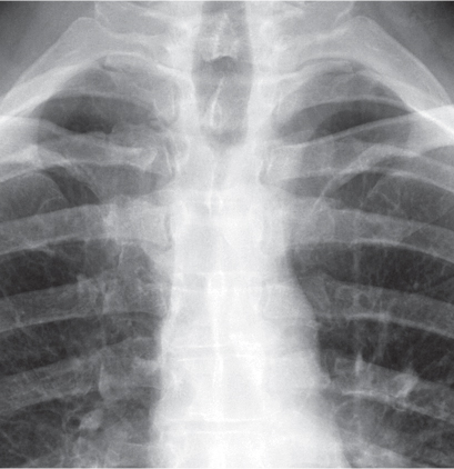 17 Tracheal Stenosis | Radiology Key