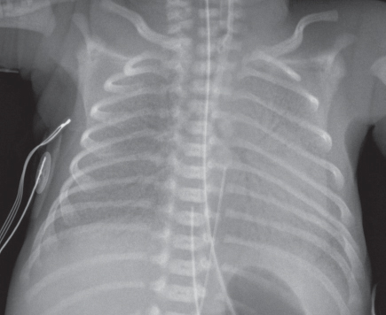 36 Adhesive Atelectasis | Radiology Key