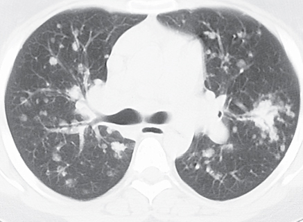 82 Primary Pulmonary Lymphoma | Radiology Key