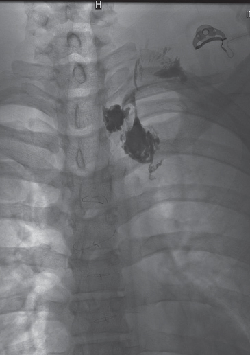 87 Chylothorax | Radiology Key