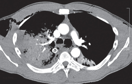 91 Tracheobronchial Injury | Radiology Key