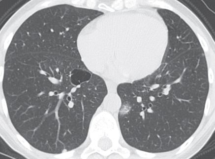 109 Lymphocytic Interstitial Pneumonia (LIP) | Radiology Key