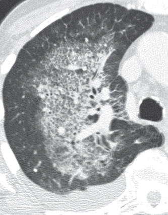 111 Diffuse Alveolar Hemorrhage | Radiology Key