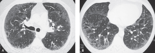 127 Hard Metal Pneumoconiosis | Radiology Key