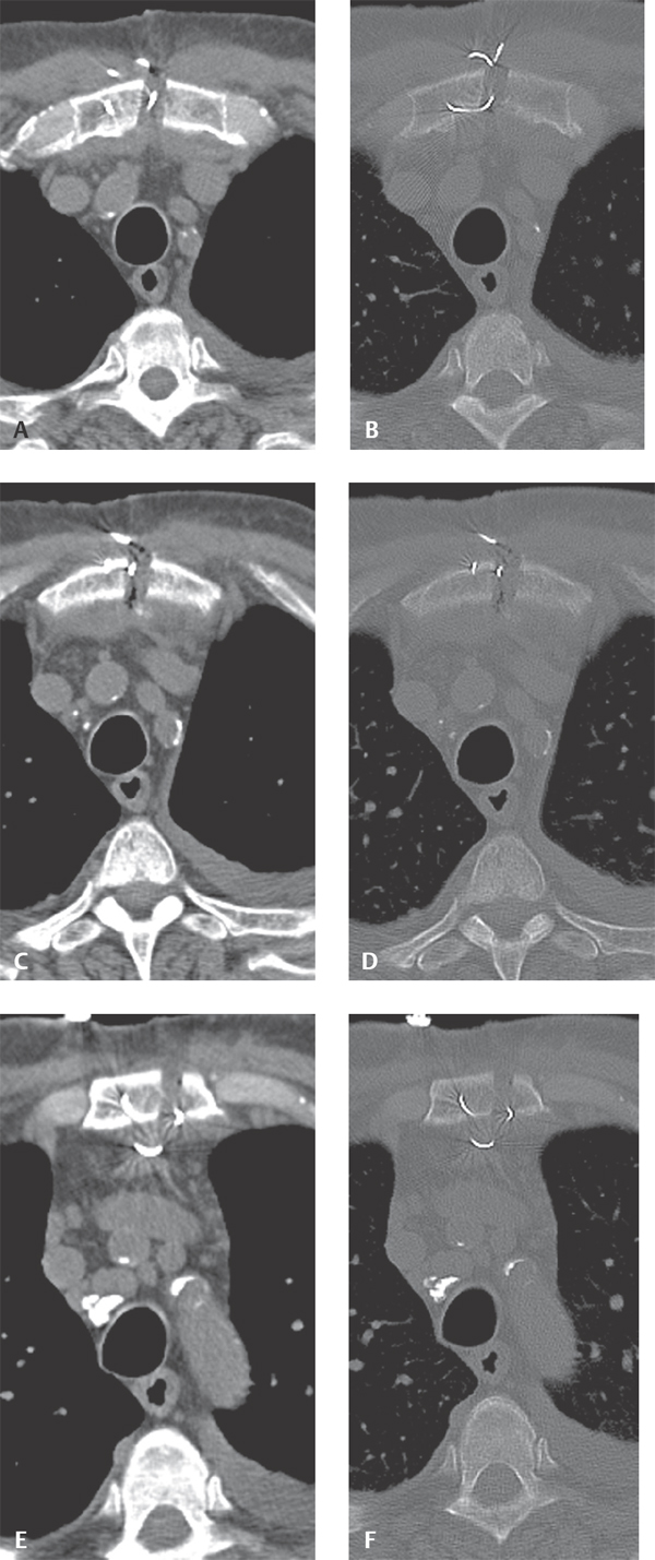 150 Sternal Dehiscence | Radiology Key
