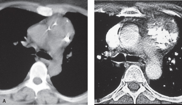 165 Lymphangioma | Radiology Key