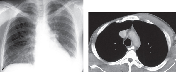 183 Pectus Excavatum | Radiology Key