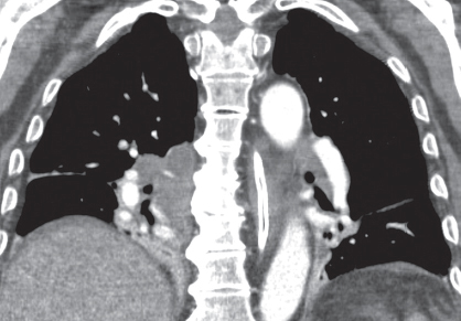 191 Post-Transplant Lymphoproliferative Disease (PTLD) | Radiology Key