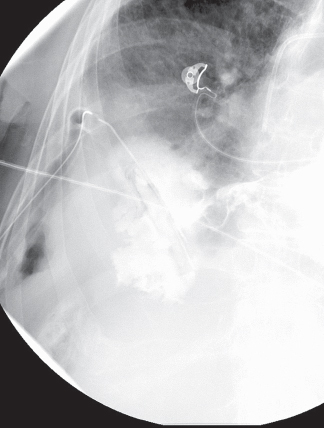 193 Postoperative Esophagectomy Chest | Radiology Key