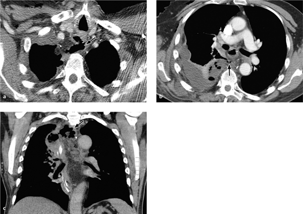 Imaging of Intensive Care Patients after Thoracic Surgery | Radiology Key