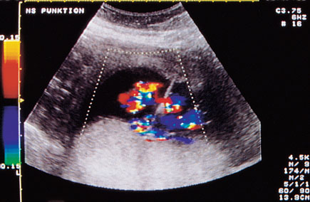 Possible Applications of Doppler Ultrasound in Fetal Anemia | Radiology Key