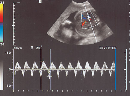 Diagnostic and Clinical Significance of Doppler Ultrasound in ...