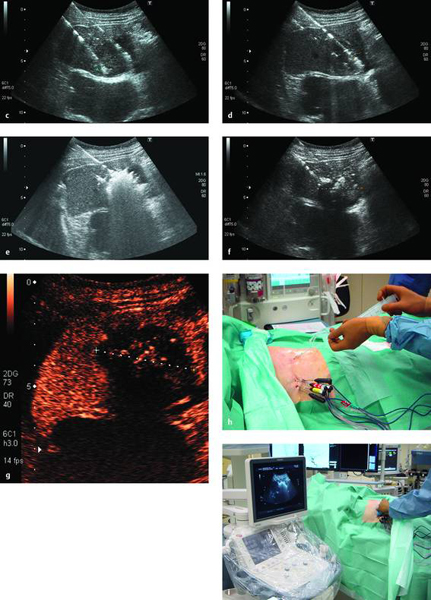 Local Ablative Procedures for Liver Tumors, Radiofrequency Ablation ...