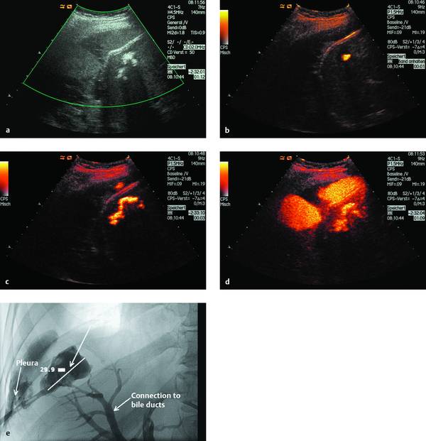 Percutaneous Transhepatic Cholangiodrainage | Radiology Key