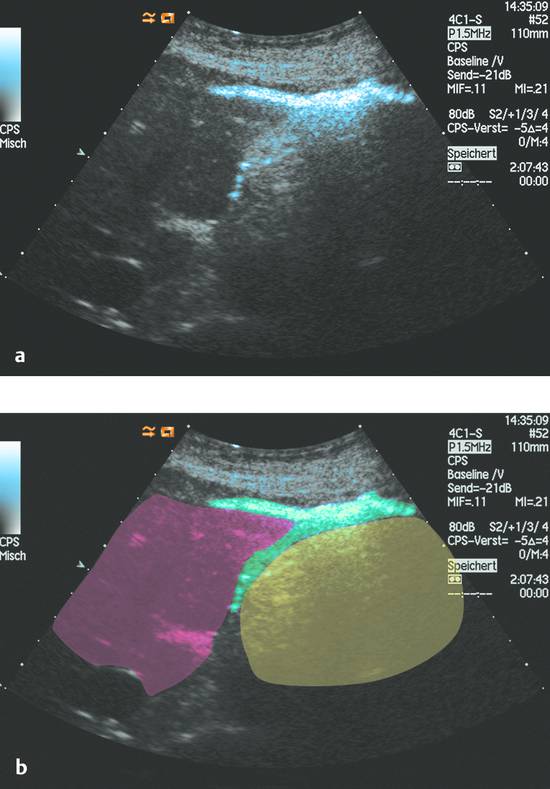 Percutaneous Gastrostomy | Radiology Key