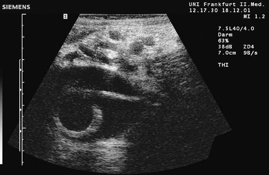 Interventional Urology | Radiology Key