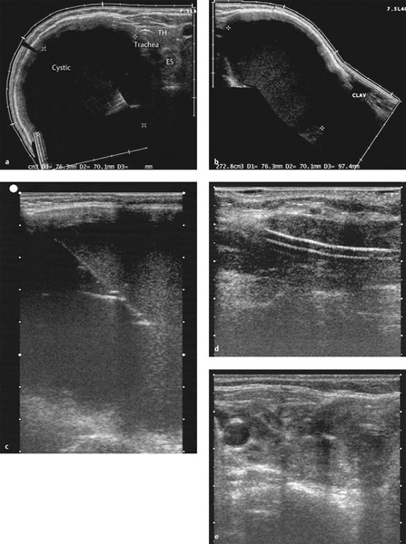Interventional Thyroid Ultrasound | Radiology Key