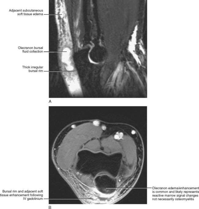 Triceps Anatomy Mri Lateral Head Of Triceps Brachii Muscle (Caput