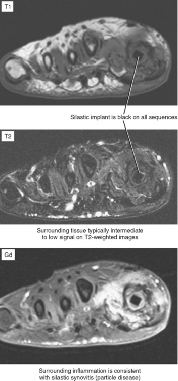 IMAGING OF THE FOREFOOT AND MIDFOOT | Radiology Key