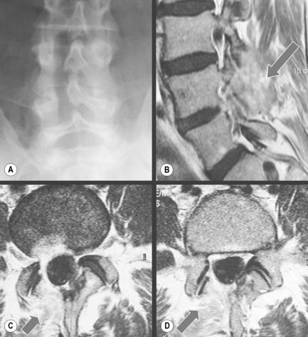The lumbar spine | Radiology Key
