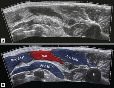 Shoulder 2: The SASD Bursa, Rotator Interval and Other Rotator Cuff ...