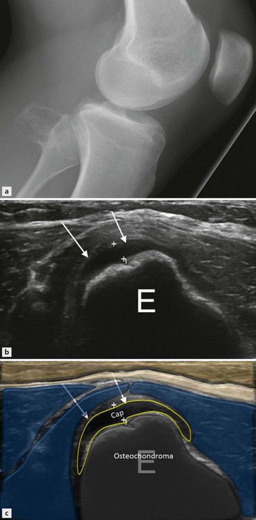 Knee Pathology | Radiology Key
