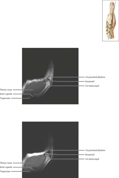 Thumb | Radiology Key
