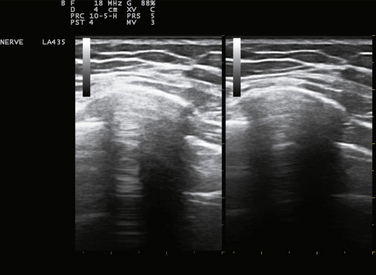 Basic Principles of Ultrasound | Radiology Key