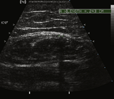 Ultrasound of Inflammatory Myopathies | Radiology Key