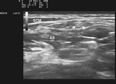 Interventional Ultrasound | Radiology Key