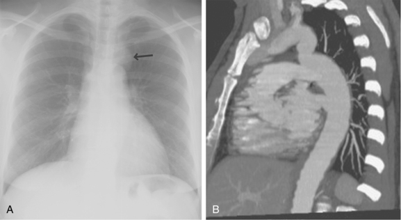 Thoracic aorta | Radiology Key