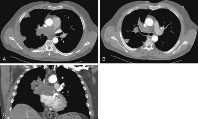 Pulmonary and bronchial arteries | Radiology Key