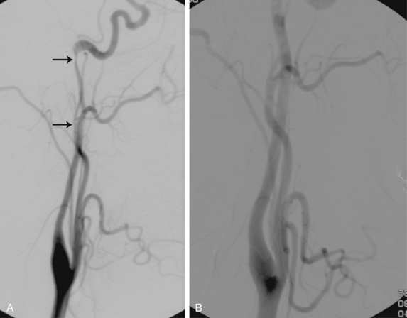 Neurointerventions | Radiology Key