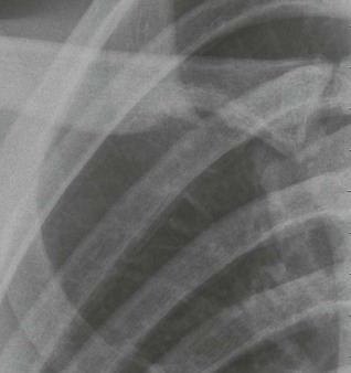 Shoulder | Radiology Key
